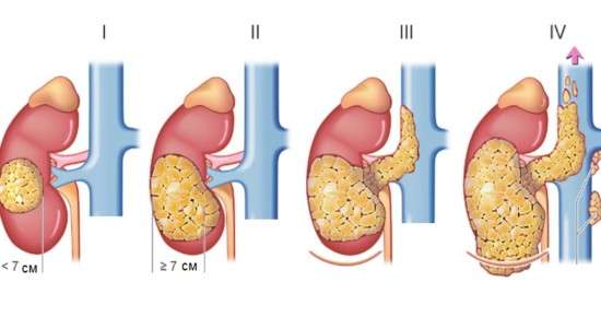 Kidney cancer symptoms and signs, kidney cancer treatment ⚕️ MedTour