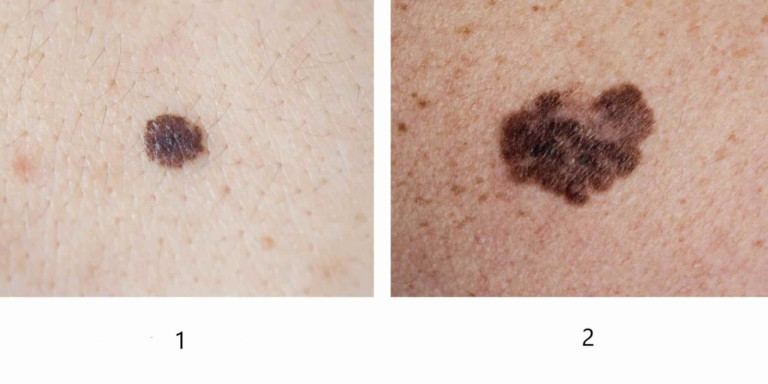 Melanoma – symptoms, causes, diagnosis and treatment in the best ... Melanoma – symptoms, causes, diagnosis and treatment in the best ...