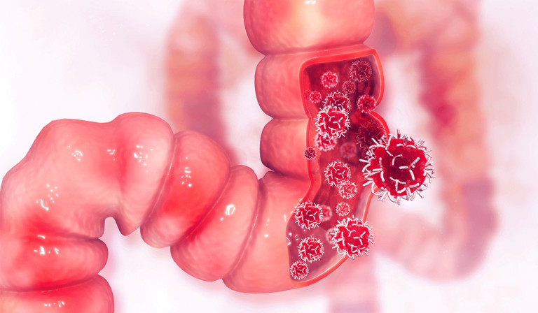 Cancer Tumor Of The Sigmoid Colon Symptoms Diagnosis And Treatment In The Best Clinics